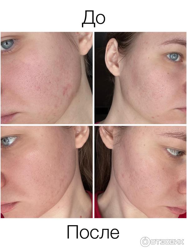 Отзыв о Сыворотка для лица Orele Calicylic Acid | Сыворотка для лица ...