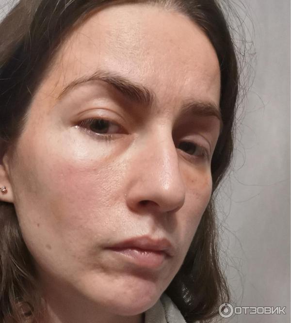 Отзыв о Безоперационная пластика лица Радиесс | Много крови, отёков ...