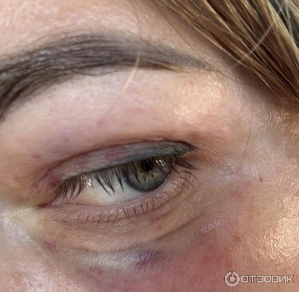 Отзыв о Биоревитализант Revi Eye | Не понравился